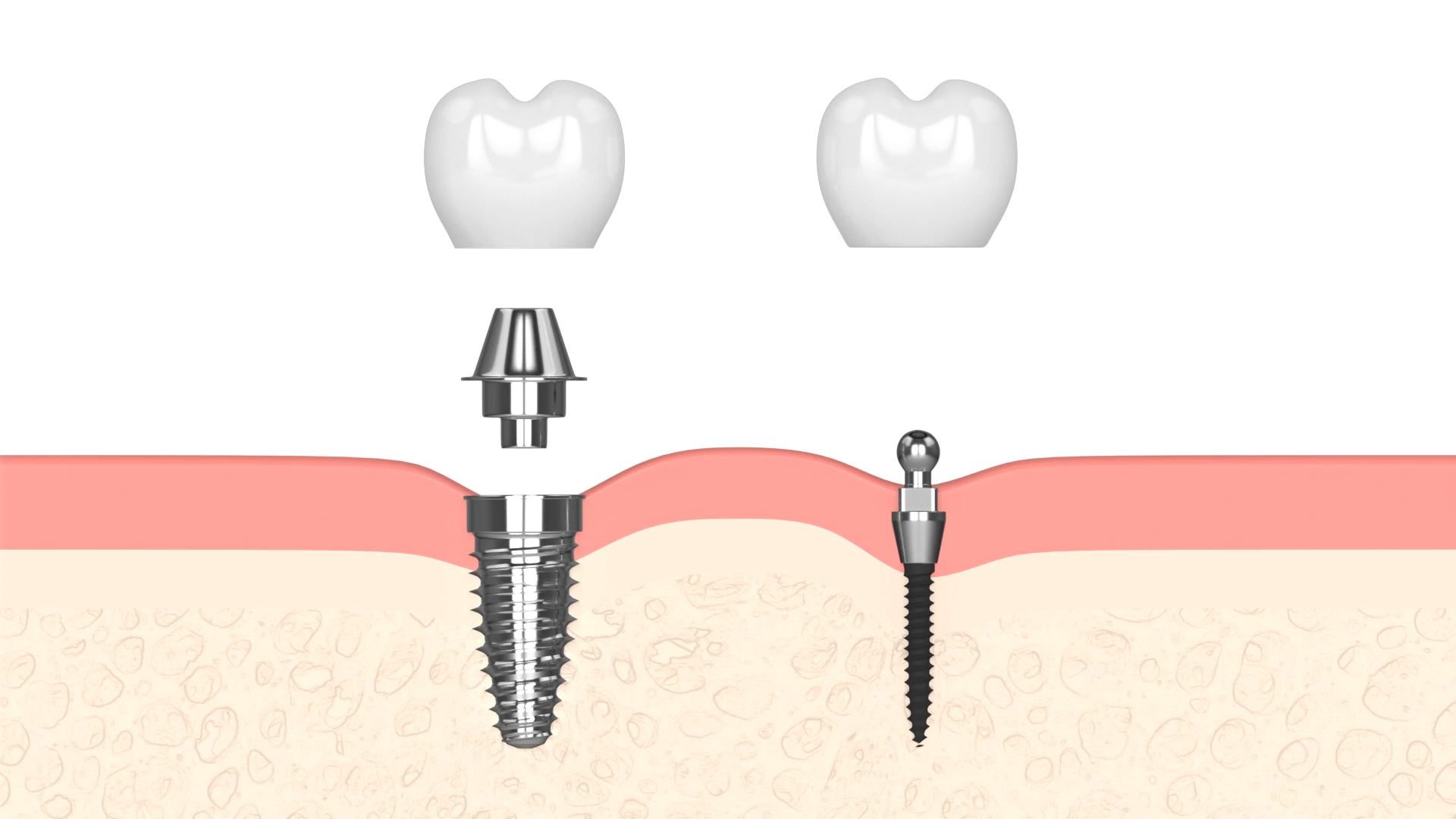 Mini Dental Implants in Emeryville, CA | Dr. Rose Magno